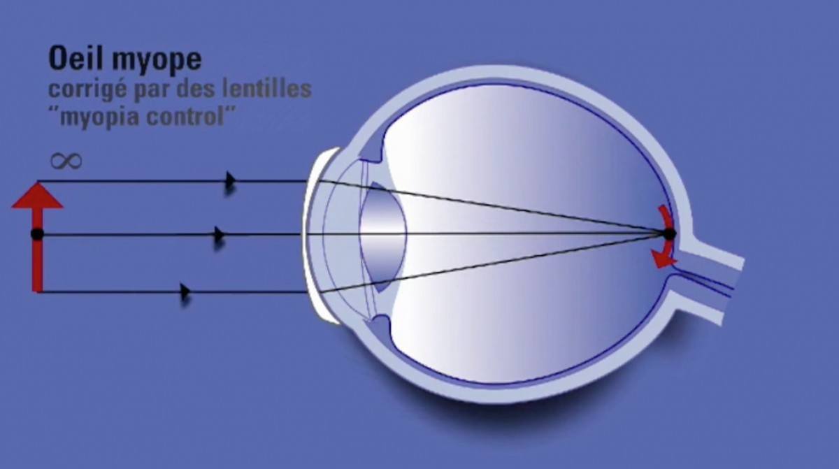 Myopia, its causes and therapy (Video in French) - The ELZA Institute