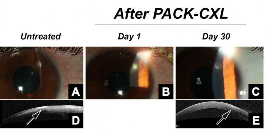 PACK-CXL in fungal keratitis - The ELZA Institute