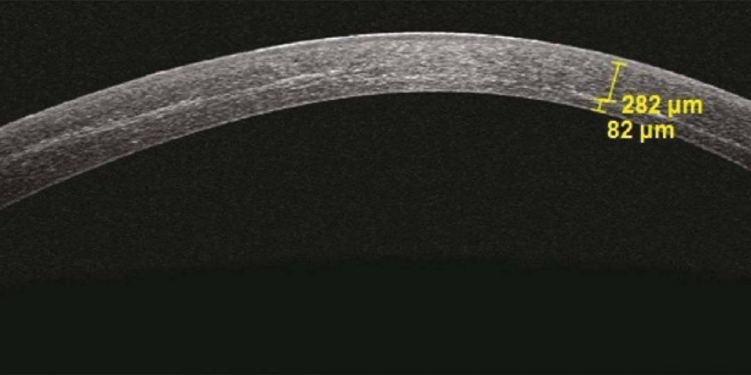 My keratoconus cornea is too thin for CXL: Cross-Linking thin cornea