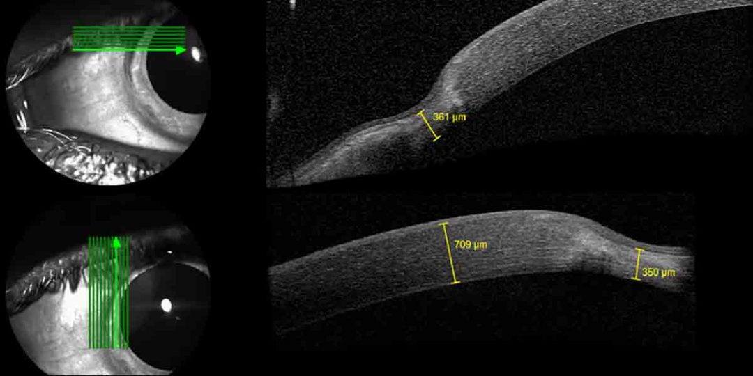 Can Cross-Linking (CXL) treat Terrien’s Marginal Degeneration (TMD ...