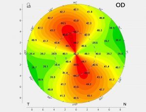 How is keratoconus discovered? - The ELZA Institute