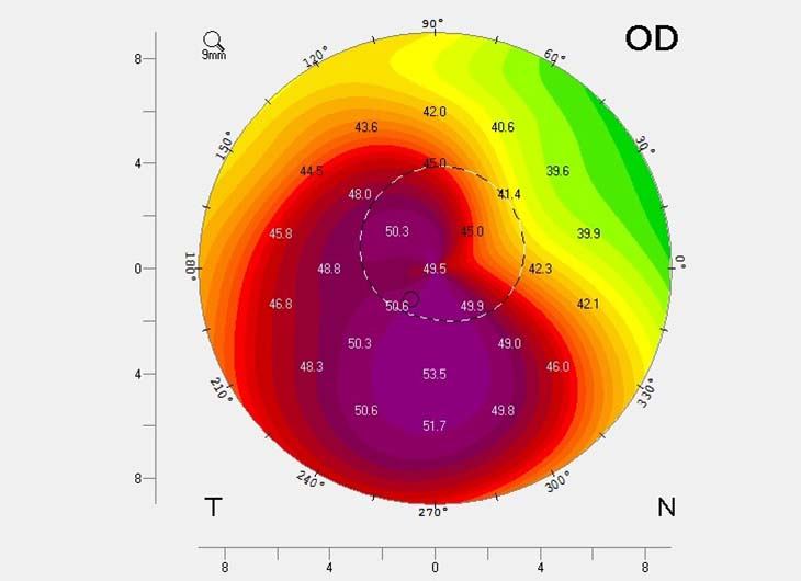 Wavefront-guided transPRK for improving visual quality