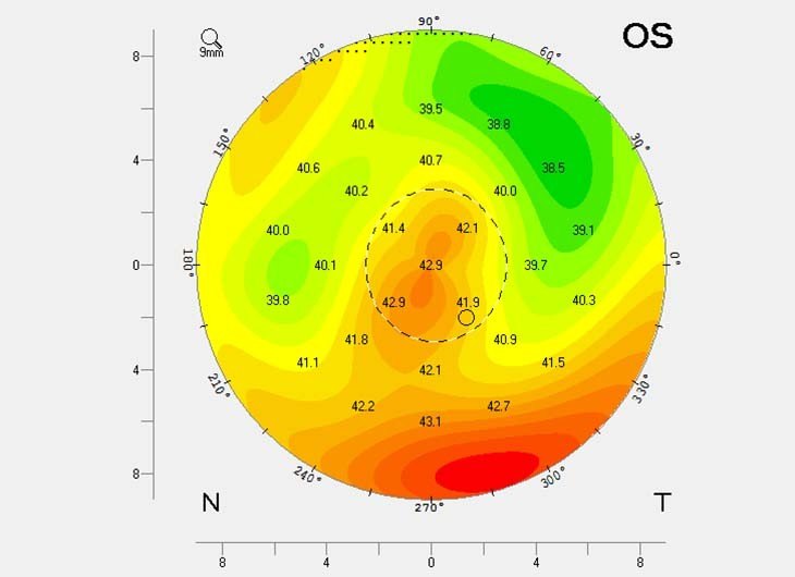 Wavefront-guided transPRK for improving visual quality