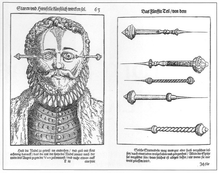 A History Of Cataracts The ELZA Institute Dietikon Zurich A History Of Cataracts The ELZA Institute Dietikon Zurich
