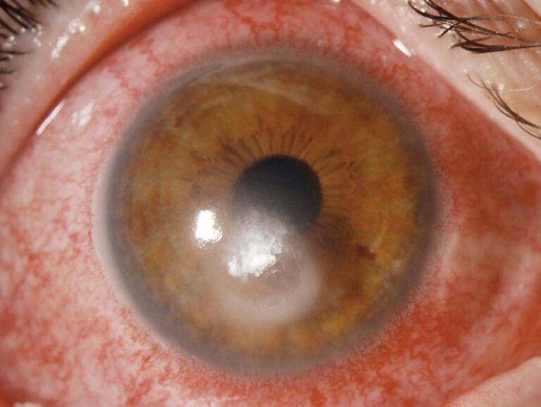 Cornea: Infectious Keratitis - The ELZA Institute, Dietikon, Zurich