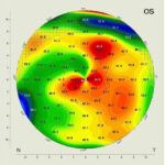 Improving vision after a corneal scar - The ELZA Institute