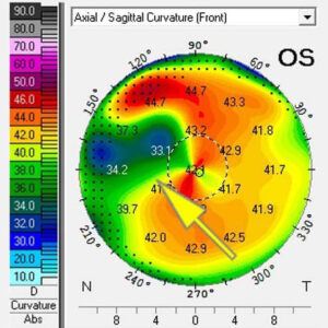 Salzmann's Nodular Degeneration of the cornea - The ELZA Institute