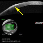 Salzmann's Nodular Degeneration of the cornea - The ELZA Institute
