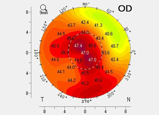 Wavefront-guided transPRK for improving visual quality