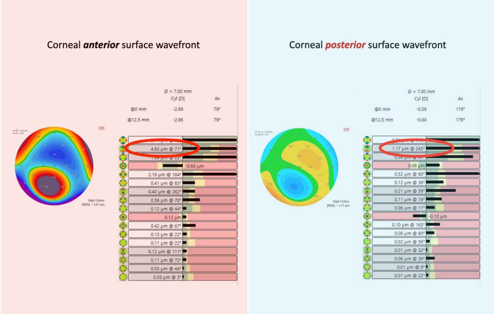 Total Corneal Wavefront Analysis in Excimer Laser Surgery