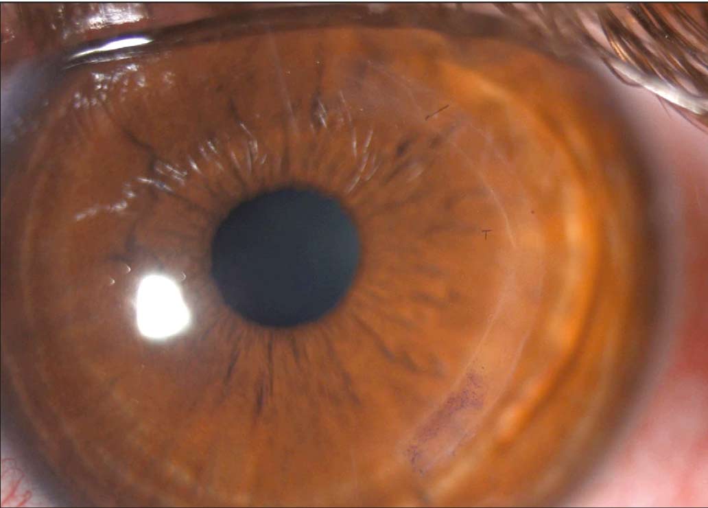 Femto-CAIRS in Keratoconus Treatment: A New Surgical Approach