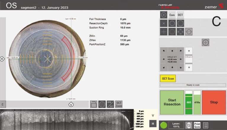 Femto-CAIRS in Keratoconus Treatment: A New Surgical Approach