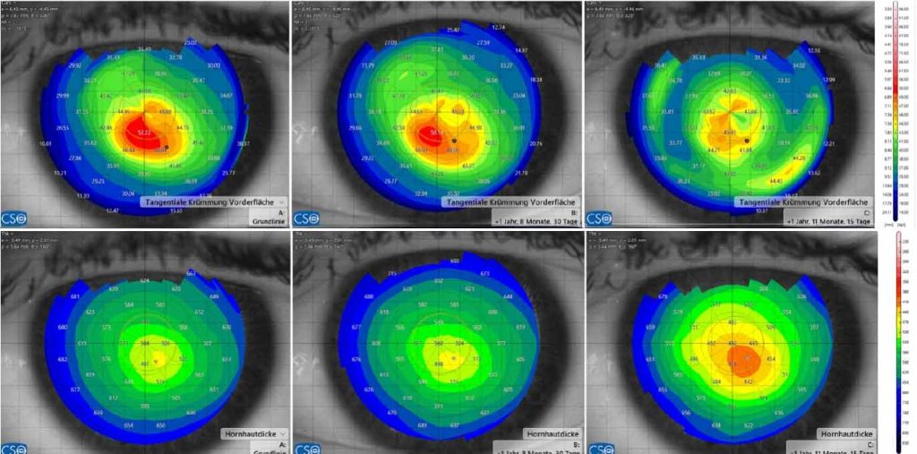 Personalized corneal cross-linking - practical scenarios - The ELZA ...